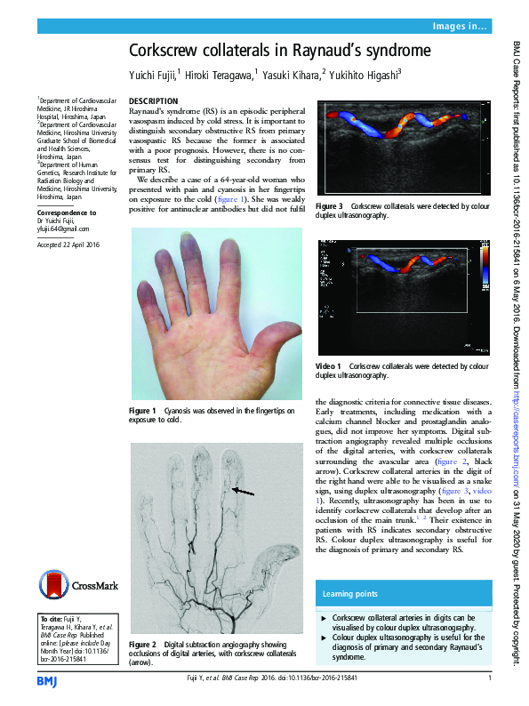 (PDF) Corkscrew collaterals in Raynaud's syndrome