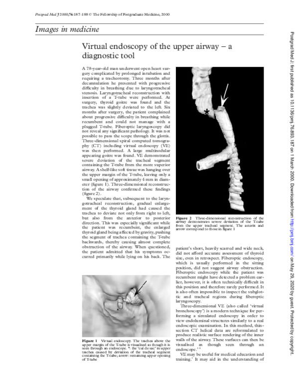 Pdf Virtual Endoscopy Of The Upper Airway A Diagnostic Tool
