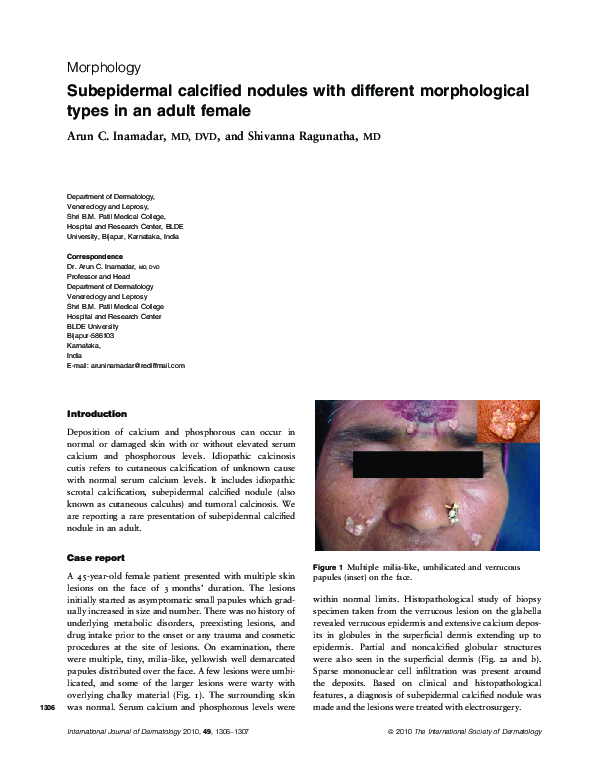 (PDF) Subepidermal calcified nodules with different morphological types ...