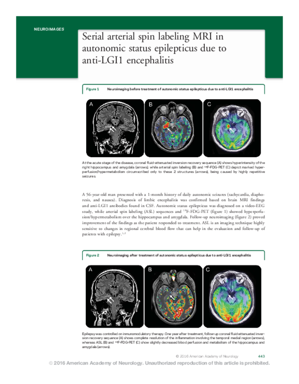 (PDF) Serial arterial spin labeling MRI in autonomic status epilepticus ...