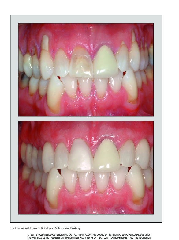 (PDF) Enhancing Root Eminence and Papilla Contour Using Single ...