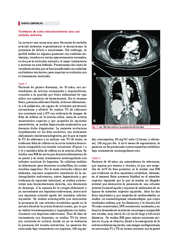 (PDF) Thrombosis of a Structurally Healthy Aorta with Systemic Embolic ...