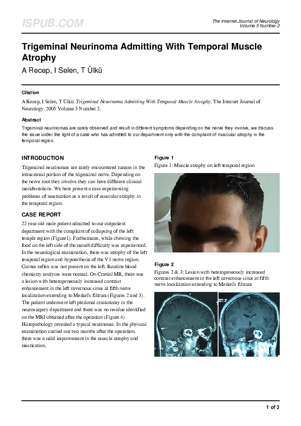 (PDF) Trigeminal Neurinoma Admitting With Temporal Muscle Atrophy