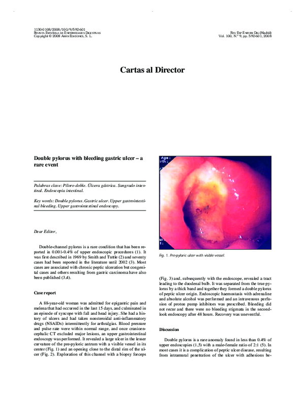 (PDF) Double pylorus with bleeding gastric ulcer: a rare event