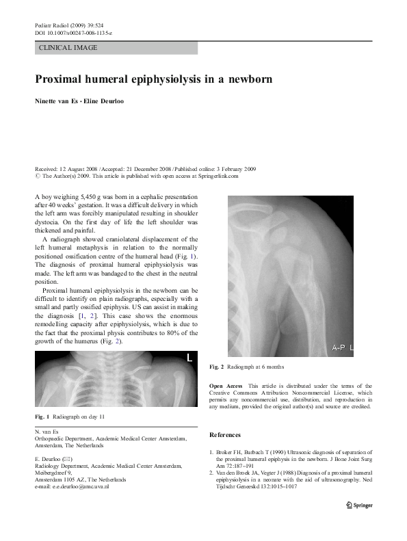 (PDF) Proximal humeral epiphysiolysis in a newborn