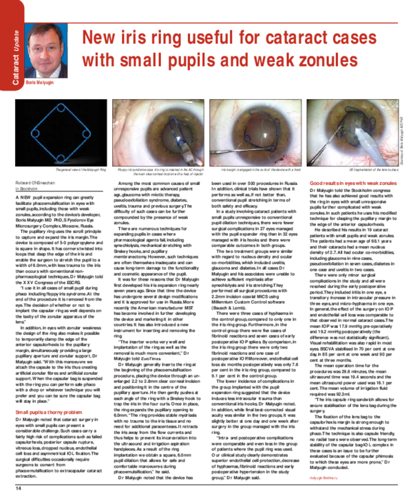 (PDF) New iris ring useful for cataract cases with small pupils and ...