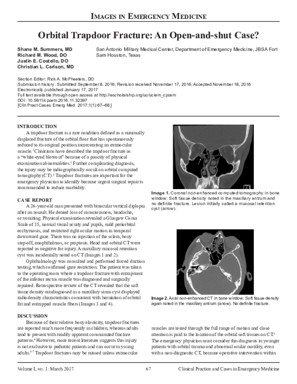 (PDF) Orbital Trapdoor Fracture: An Open-and-shut Case?