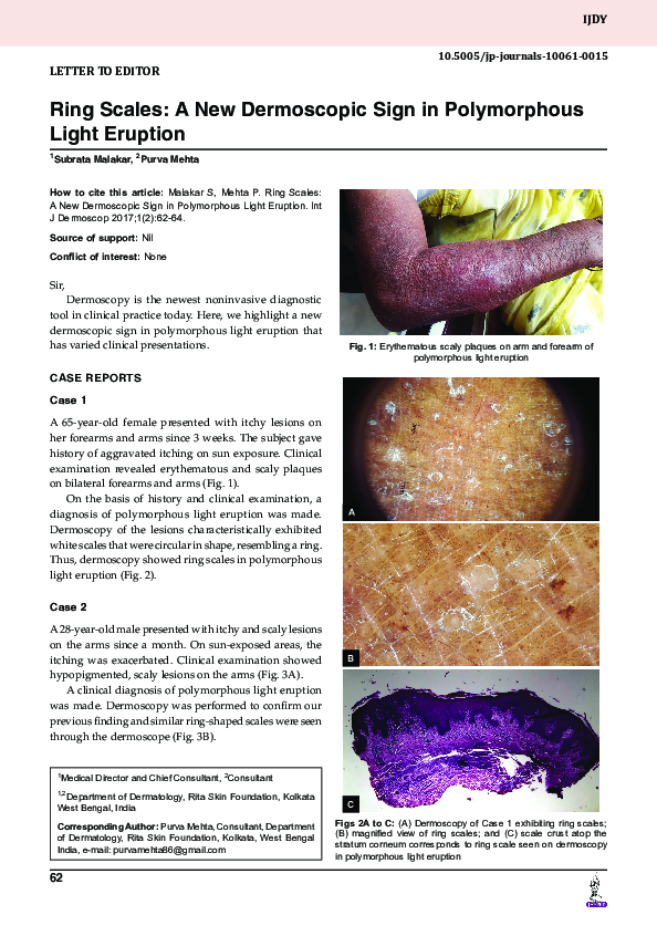 (PDF) Ring Scales: A New Dermoscopic Sign in Polymorphous Light Eruption