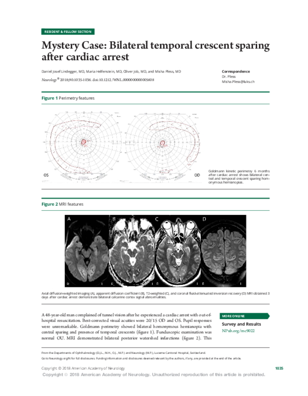 (PDF) Mystery Case: Bilateral temporal crescent sparing after cardiac ...