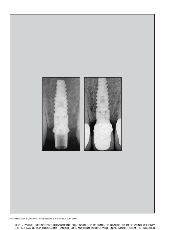 (PDF) Influence of Laser-Lok Surface on Immediate Functional Loading of Implants in Single-Tooth ...