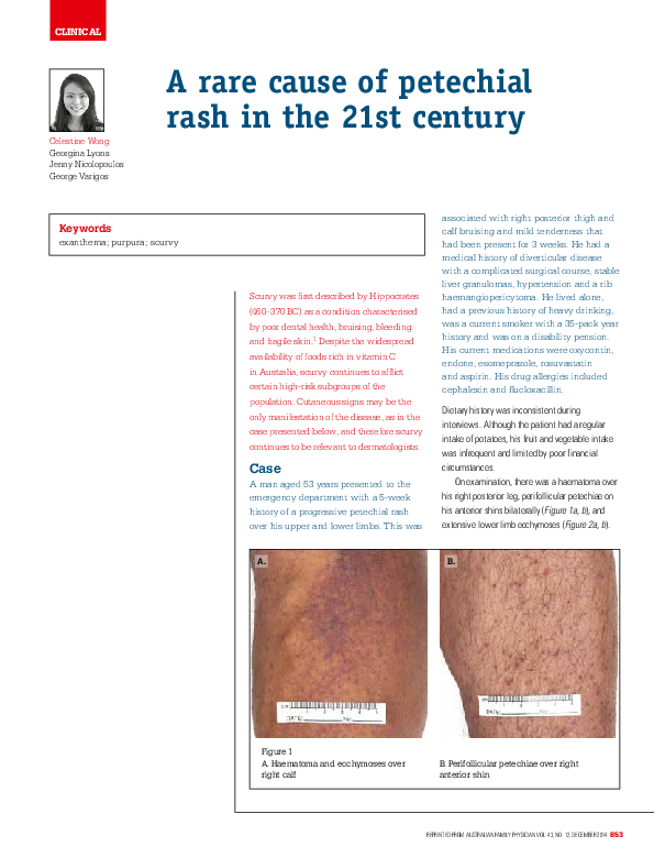 (PDF) A rare cause of petechial rash in the 21st century