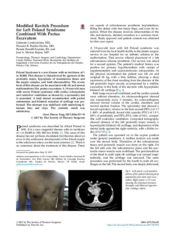 (PDF) Modified Ravitch Procedure for Left Poland Syndrome Combined With ...
