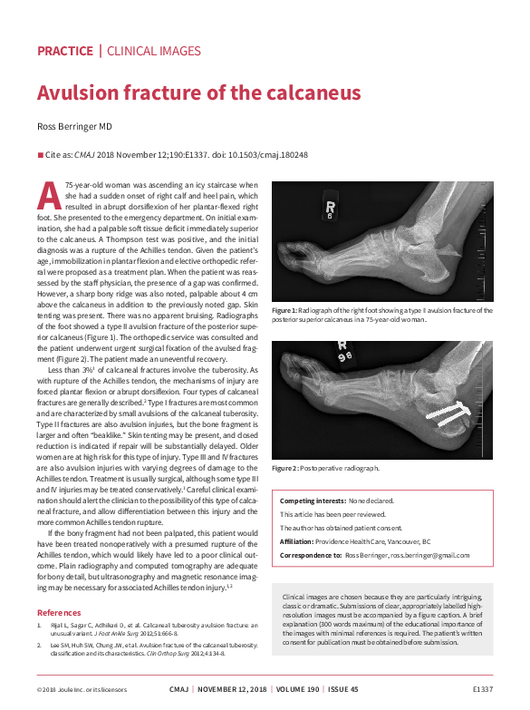 (PDF) Avulsion fracture of the calcaneus