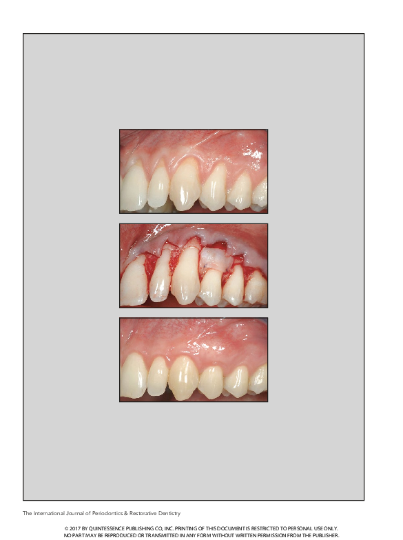 (PDF) Coronally Advanced Flap with Site-Specific Application of ...