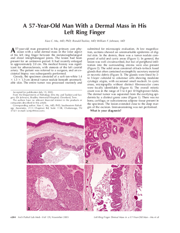 (PDF) A 57-Year-Old Man With a Dermal Mass in His Left Ring Finger
