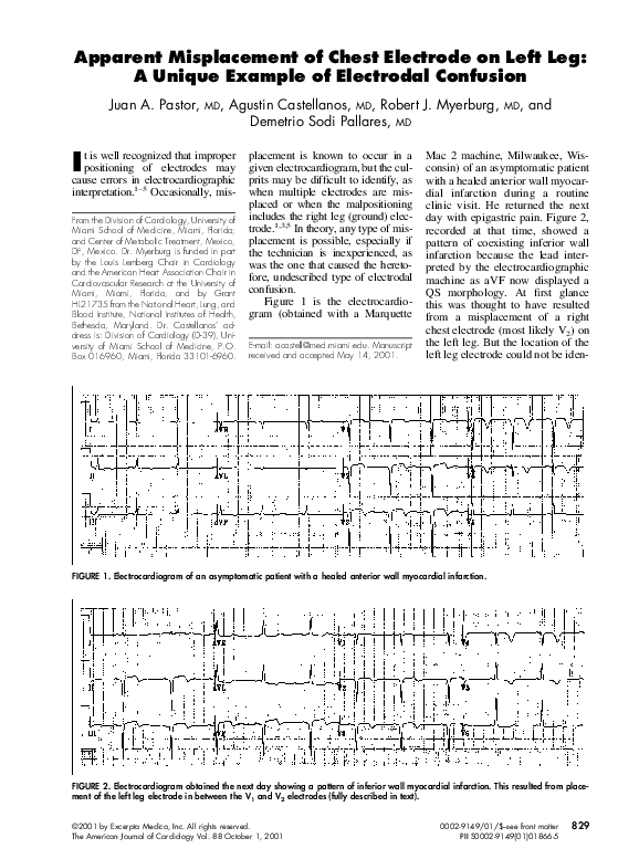 (PDF) Apparent misplacement of chest electrode on left leg: a unique ...
