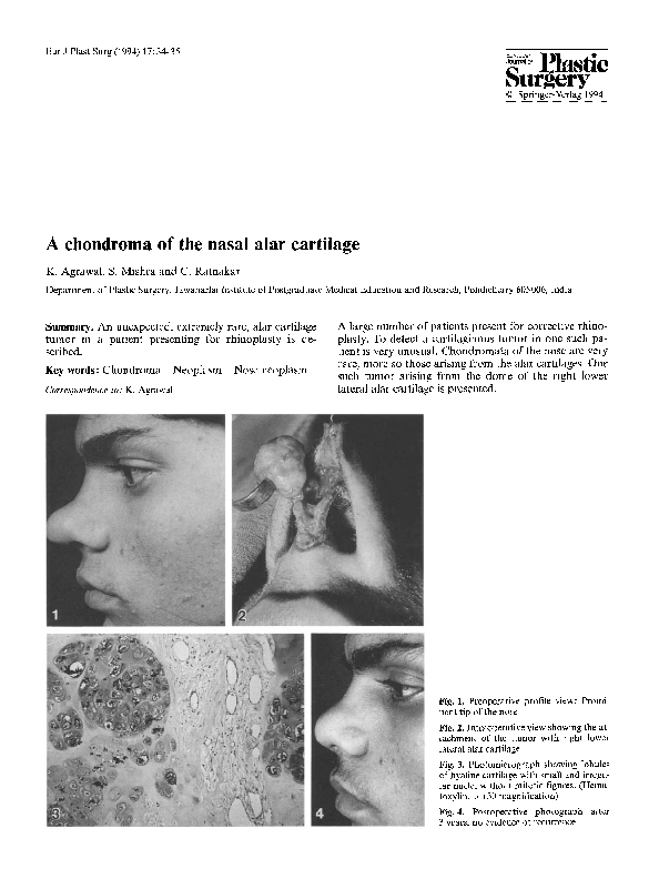 (PDF) A chondroma of the nasal alar cartilage