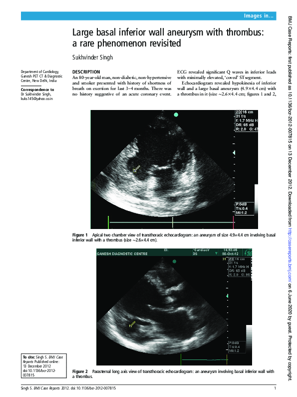 (PDF) Large basal inferior wall aneurysm with thrombus: a rare ...