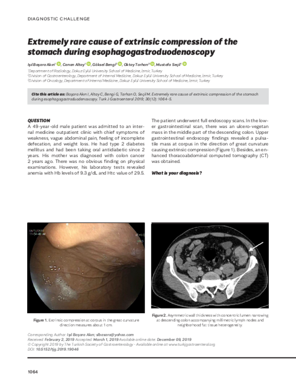 (PDF) Extremely rare cause of extrinsic compression of the stomach ...