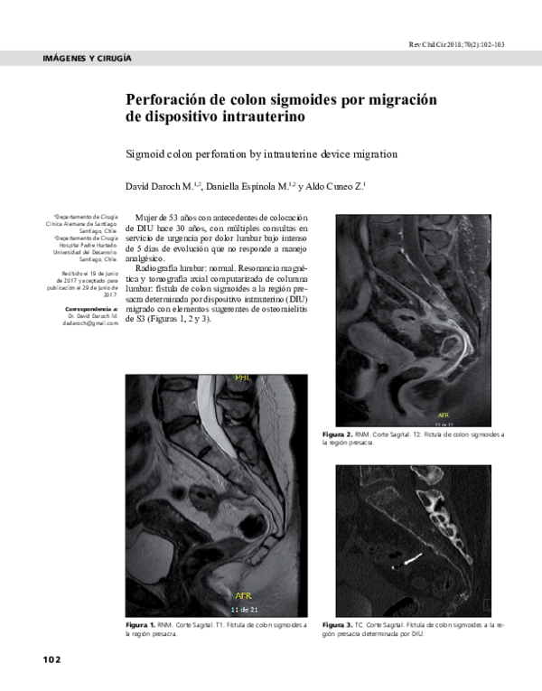 (PDF) Perforación de colon sigmoides por migración de dispositivo ...