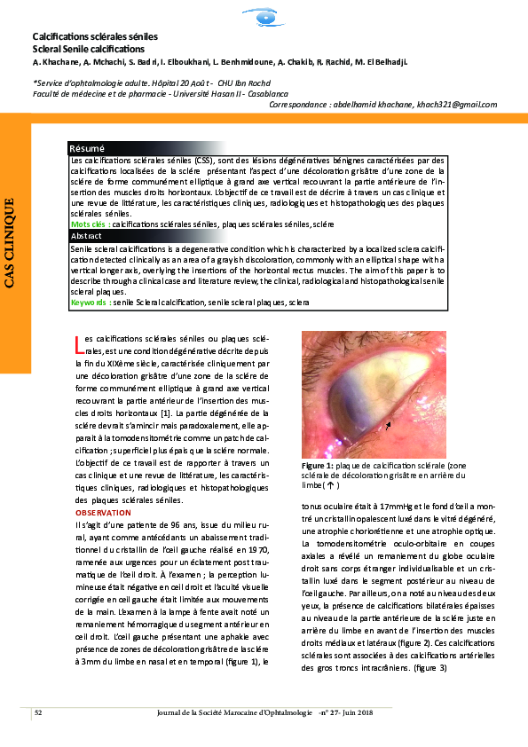 (PDF) Calcifications sclérales séniles