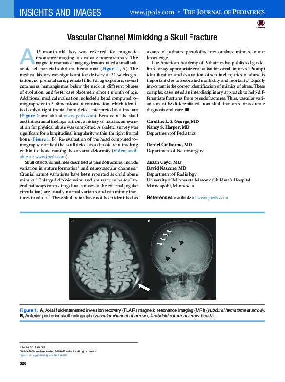 (PDF) Vascular Channel Mimicking a Skull Fracture