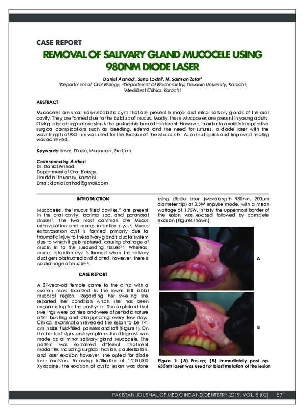 (PDF) Removal of Salivary Gland Mucocele Using 980NM Diode Laser