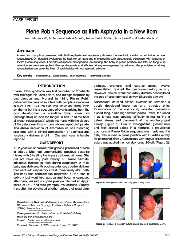 (PDF) Pierre robin sequence as birth asphyxia in a new born