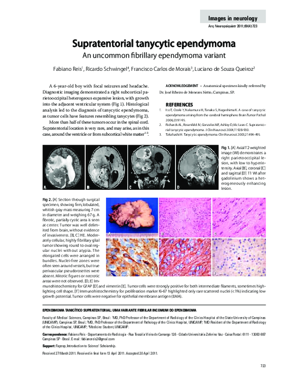 (PDF) Supratentorial tanycytic ependymoma: an uncommon fibrillary ...