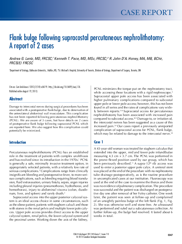 (PDF) Flank bulge following supracostal percutaneous nephrolithotomy: A ...