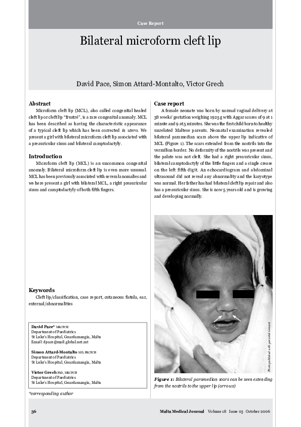 (PDF) Bilateral microform cleft lip Case report | Simon Montalto ...