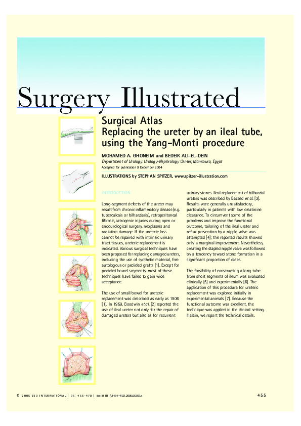 (PDF) Replacing the ureter by an ileal tube, using the Yang-Monti procedure