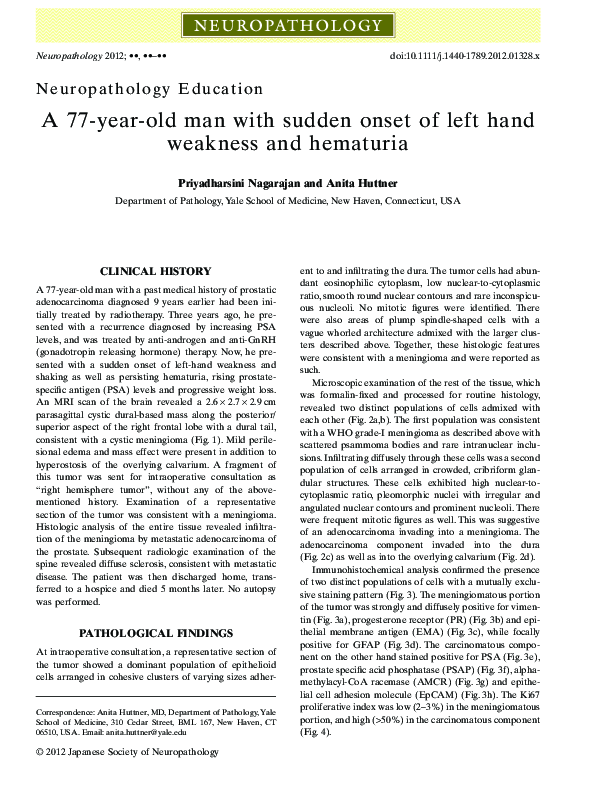(PDF) A 77-year-old man with sudden onset of left hand weakness and ...