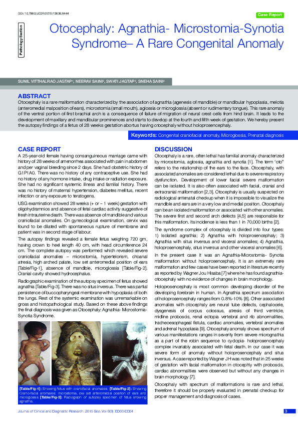 (PDF) Otocephaly: Agnathia- Microstomia-Synotia Syndrome– A Rare ...