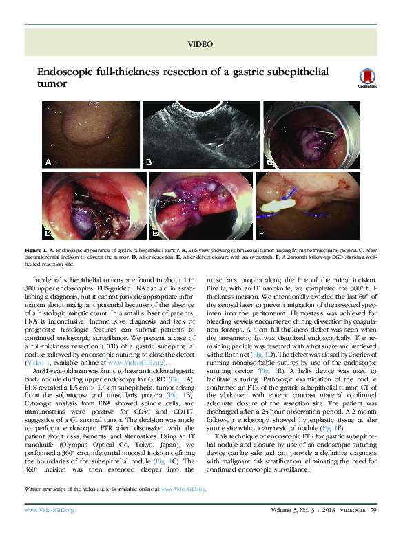 (PDF) Endoscopic full-thickness resection of a gastric subepithelial tumor