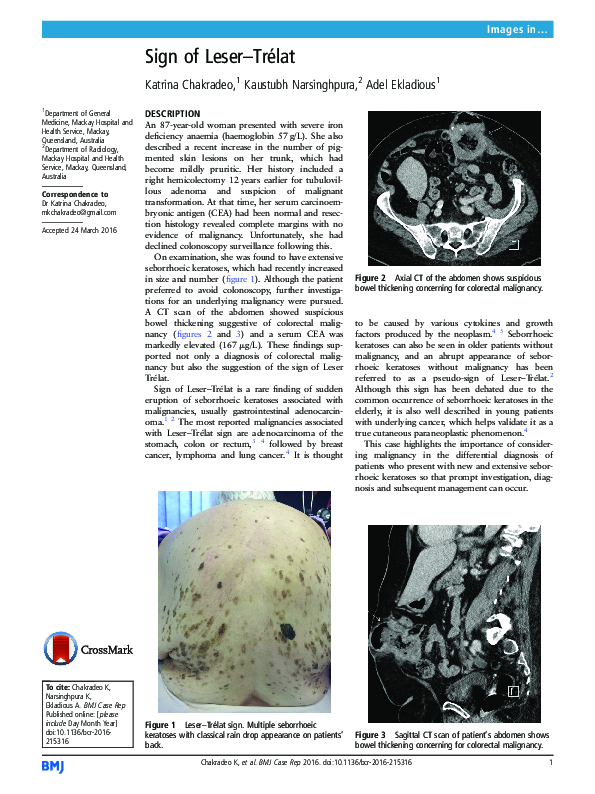 (PDF) Sign of Leser–Trélat