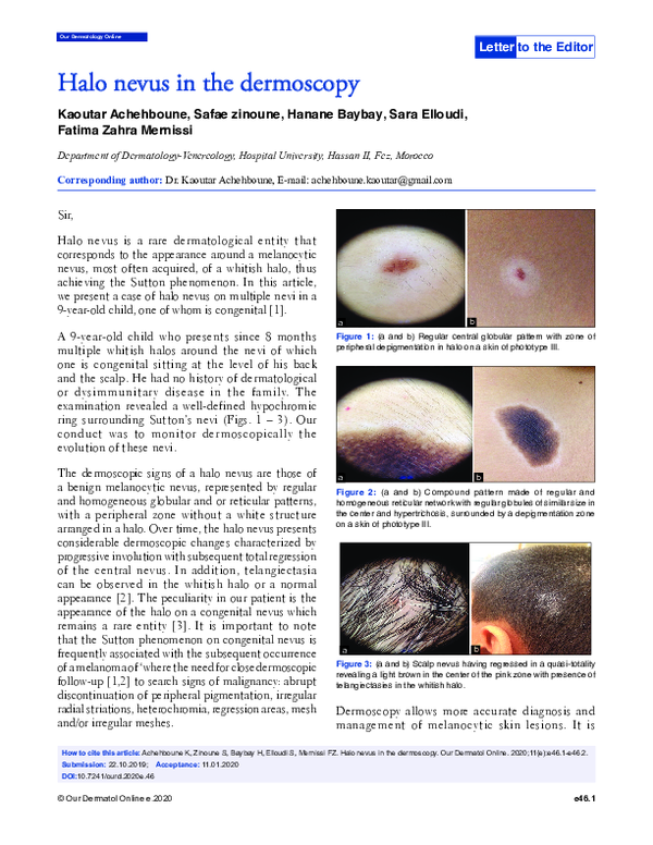 (PDF) Halo nevus in the dermoscopy