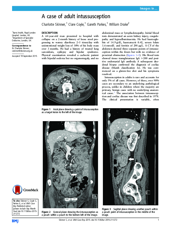 (PDF) A case of adult intussusception