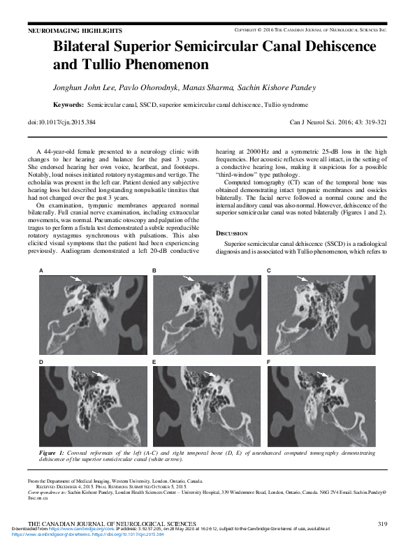 (PDF) Bilateral Superior Semicircular Canal Dehiscence and Tullio ...