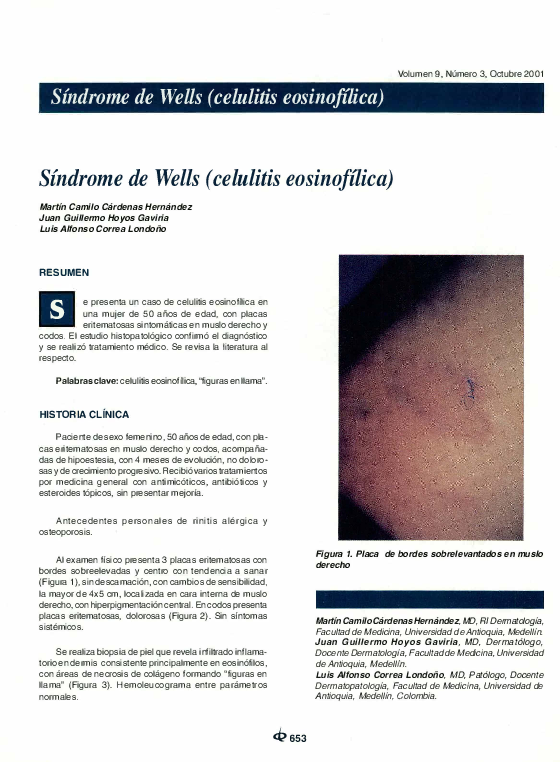 (PDF) Síndrome de Wells (celulitis eosinofi1ica)