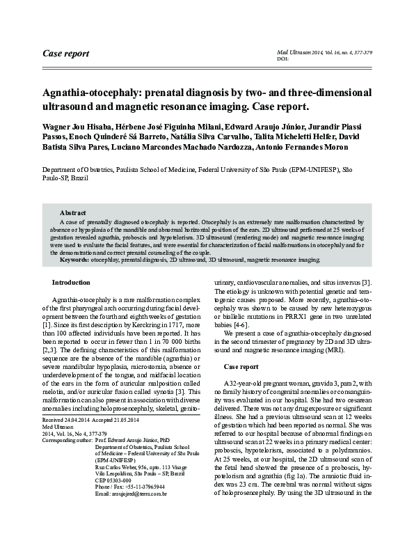 (PDF) Agnathia-otocephaly: prenatal diagnosis by two- and three ...