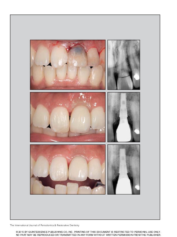 (PDF) Immediate Implant Placement and Loading of Single Implants in the ...