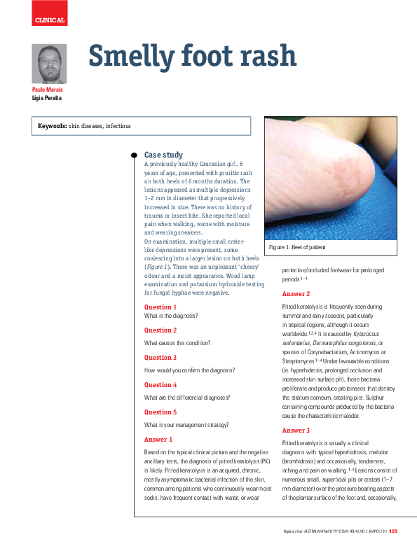(PDF) Smelly foot rash