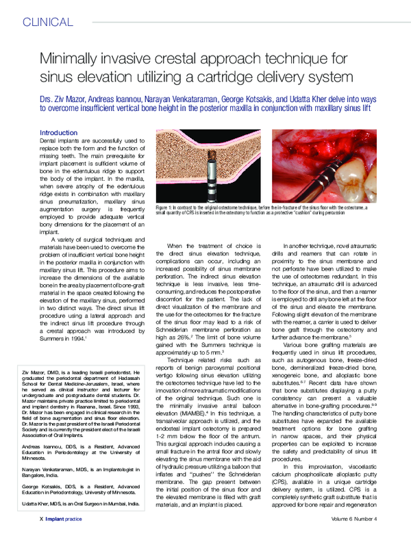 (PDF) Minimally invasive crestal approach technique for sinus elevation ...