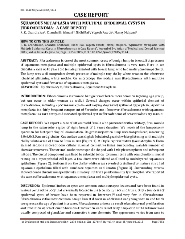 (PDF) Squamous Metaplasia with Multiple Epidermal Cysts in Fibroadenoma ...