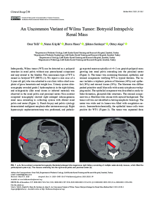 (PDF) An Uncommon Variant of Wilms Tumor: Botryoid Intrapelvic Renal Mass