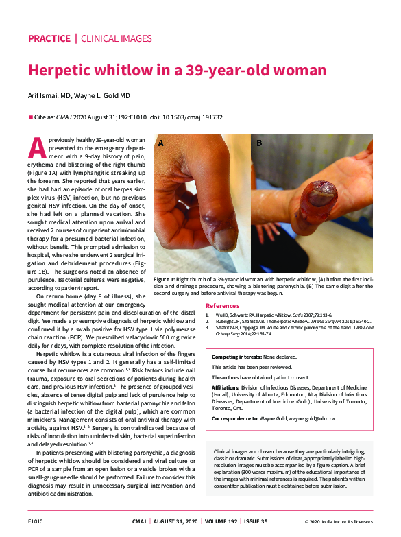 (PDF) Herpetic whitlow in a 39-year-old woman