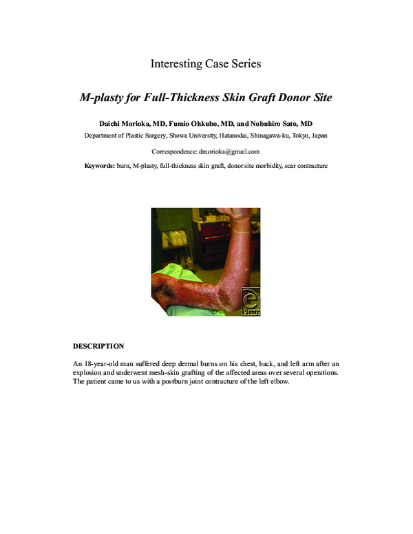(PDF) M-plasty for Full-Thickness Skin Graft Donor Site