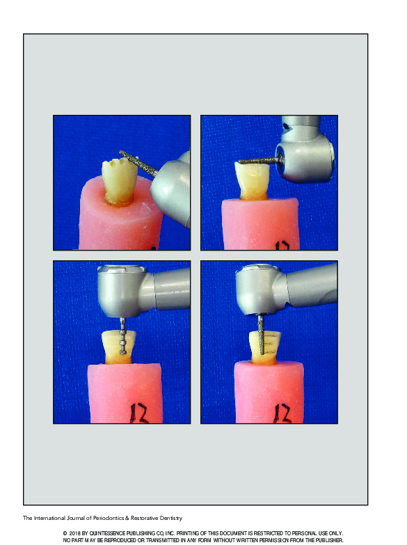 Marginal Adaptation and Fracture Resistance of Lithium Disilicate ...