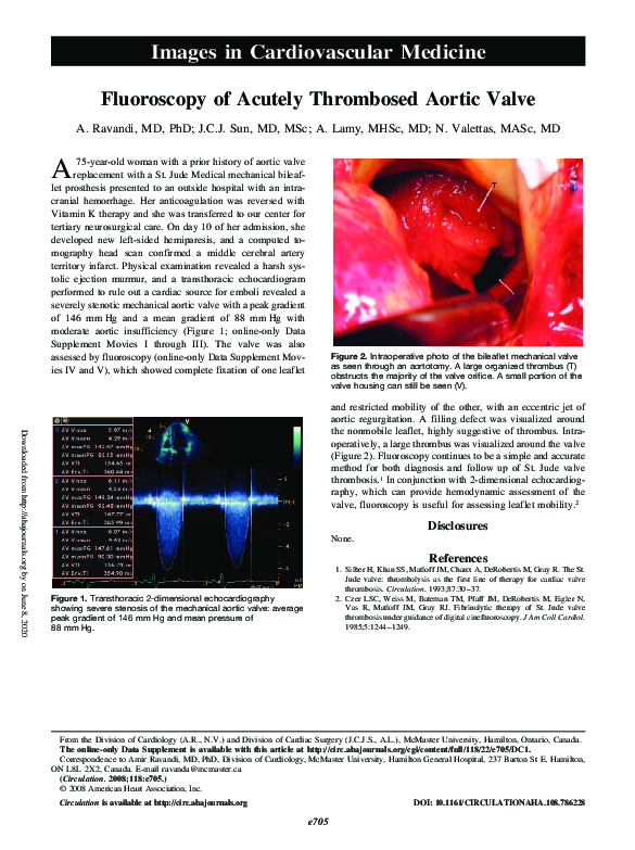 (PDF) Fluoroscopy of Acutely Thrombosed Aortic Valve